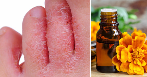 Tagetes Essential Oil: 9 Health Uses - David Wolfe Shop