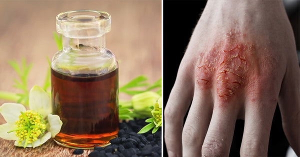 Black Seed Oil Benefits: Wiping Out Infections, Restoring Hair & More ...