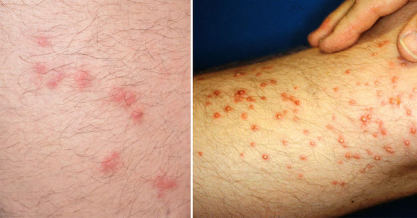 7 Common Bug Bites & How To Identify Them - David Wolfe Shop