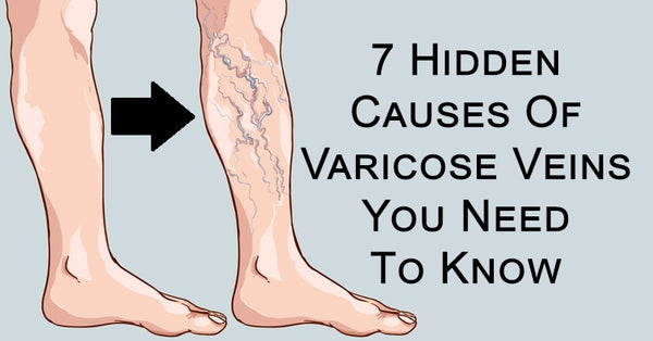 7 Hidden Causes Of Varicose Veins You Need To Know - David Wolfe Shop