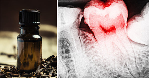 Clove Oil: 7 Uses & Benefits - David Wolfe Shop