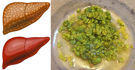 The Amazing Liver Gallbladder Flush Protocol (And My SHOCKING Results ...