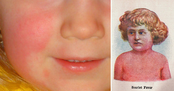 9 Common Symptoms Of Scarlet Fever Every Parent Should Watch Out For ...