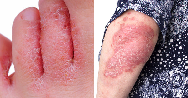 9 Skin Problems You Can Treat With Tea Tree Oil - David Wolfe Shop